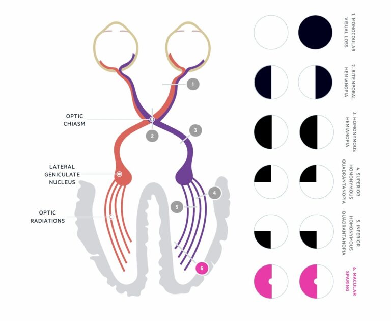 Visual Field Defects Classification - Oculab Blog